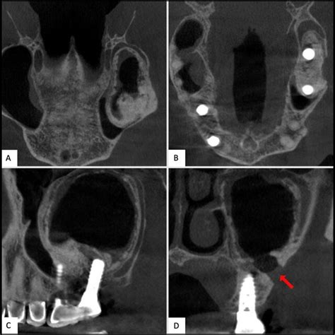 A Opt After Extraction Of The Upper Second Molar Sinus Augmentation
