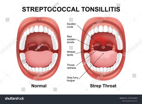 Streptococcal Tonsillitis Strep Throat Bacterial Infection Stock Illustration 2505619869