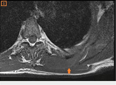Figure 1 From A Case Of Myxoma Mimicking Scapulothoracic Bursa Semantic Scholar