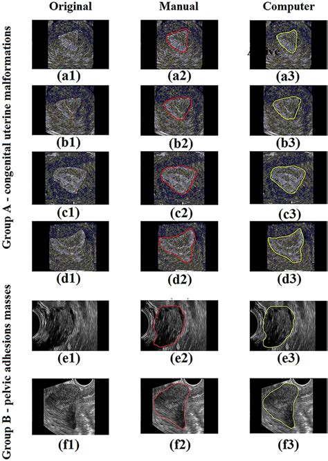 Gynecology Ultrasound Scans With Segmentation Of Uterus By Active