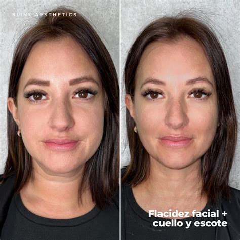 Ultrasonic 9d · Lifting Facial Centros Blink