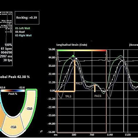 Strain Analysis Of Left Atrium La For Calculating Peak Atrial