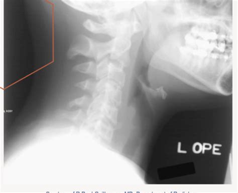 Pulm Peds Lecture Flashcards Quizlet Pulm Peds Lecture Flashcards Quizlet
