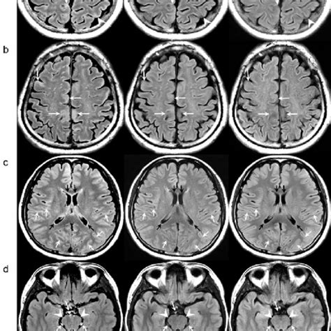 Representative Results Of Synthetic Fluid Attenuated Inversion Recovery Download Scientific