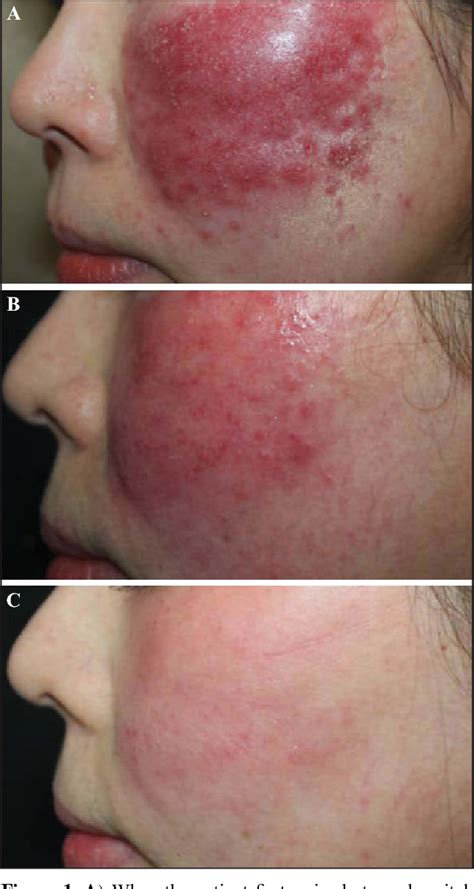 Steroid Rosacea