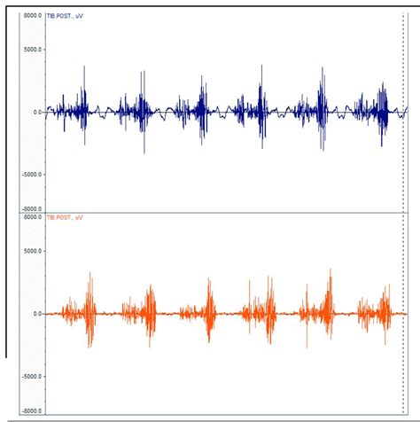 PDF ABC Of EMG