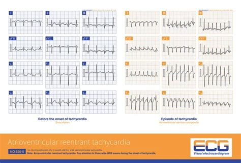 Left Posterior Fascicular Block Ecg Showed Right Axis 40 Off