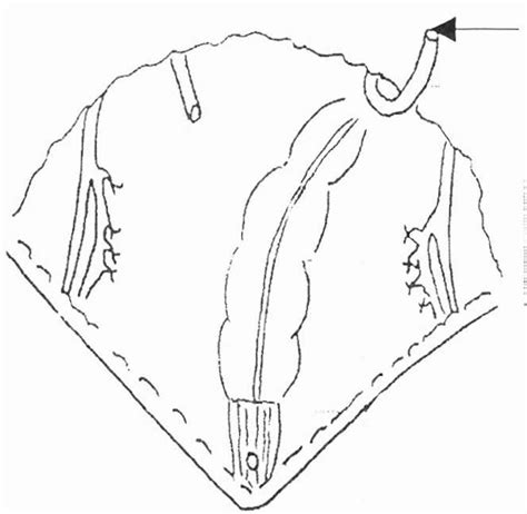A Bladder And Lymph Nodes Removed Download Scientific Diagram