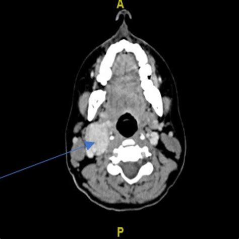 Contrast Enhanced Computed Tomography Demonstrated A Focal Rounded