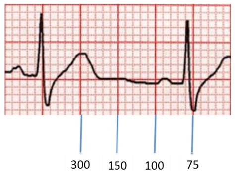 Ecg Basics Rebel Em Emergency Medicine Blog