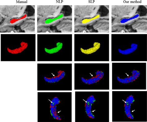 Hippocampal Segmentation Results By Different Methods The First Row Download Scientific