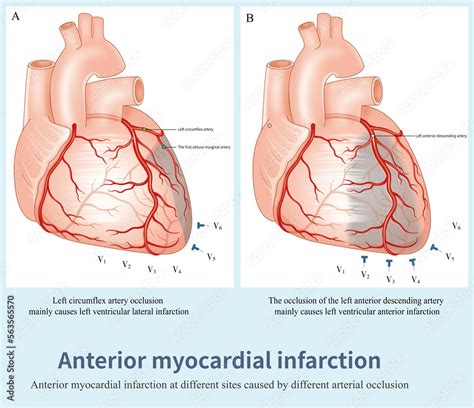 Left Anterior Descending Artery Occlusion Causes Left Ventricular