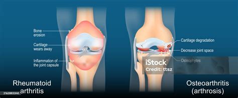 Rheumatoid Arthritis And Osteoarthritis Comparison Between A Arthrosis