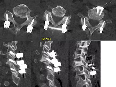 Pseudarthrosis Cervical Spine Ppt