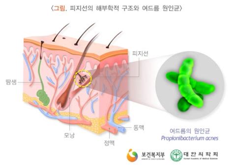크레오신 완벽 후기여드름 치료제