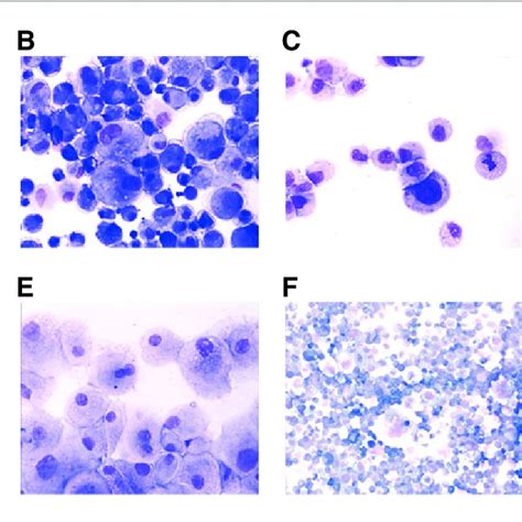 Primary Bone Sarcoma And Sts Cell Cultures Primary Tumor Cell Cultures Download Scientific