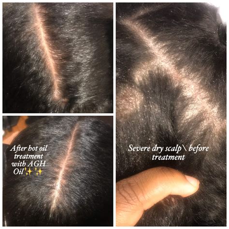 Dry Scalp Patches