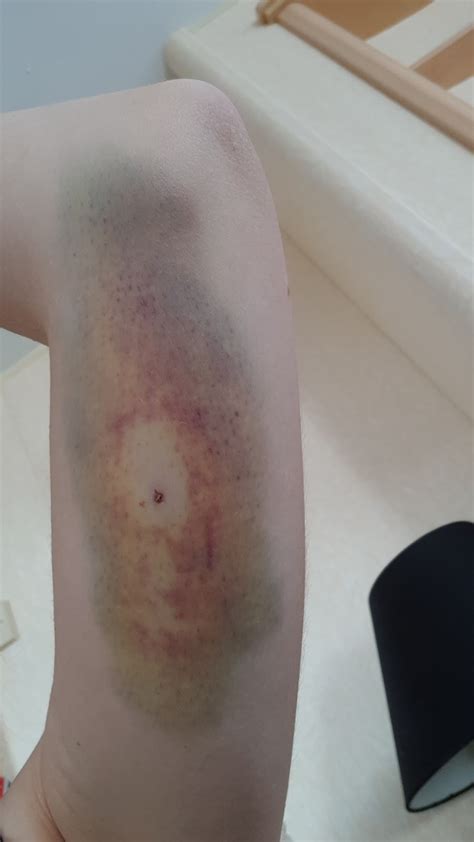 Infection 10 Months After Insertion Of Nexplanon Implant