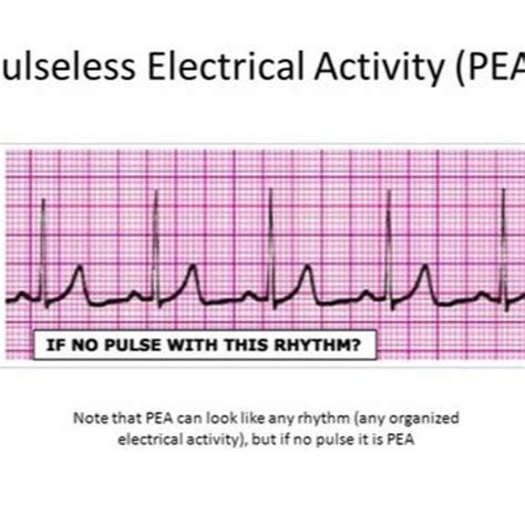 Stream Pulseless Electrical Activity Pdf Free Fixed By Yeudabuchtb Listen Online For Free On