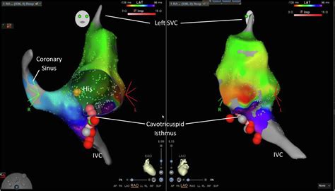 Ablation Of Atrial Flutter In A Pediatric Patient With Heterotaxy And Dextrocardia Via Superior