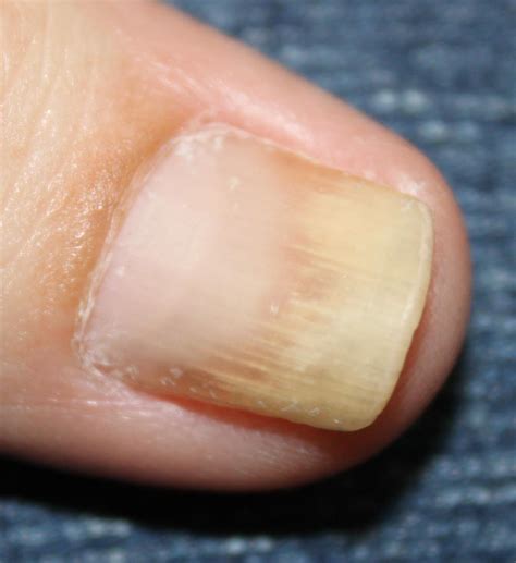 Onycholysis Psoriasis