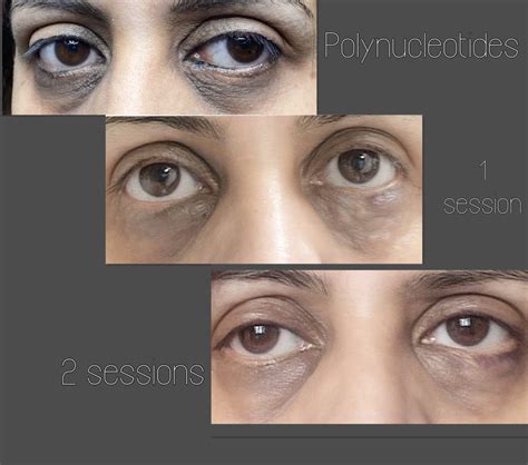 The Ultimate Polynucleotide Treatment For Skin Rejuvenation 5 Proven