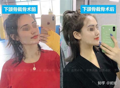 深圳的罗奇磨骨技术怎么样？ 知乎