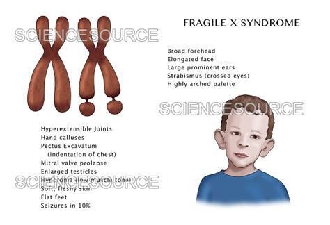 Fragile X Syndrome Illustration Stock Image Science Source Images