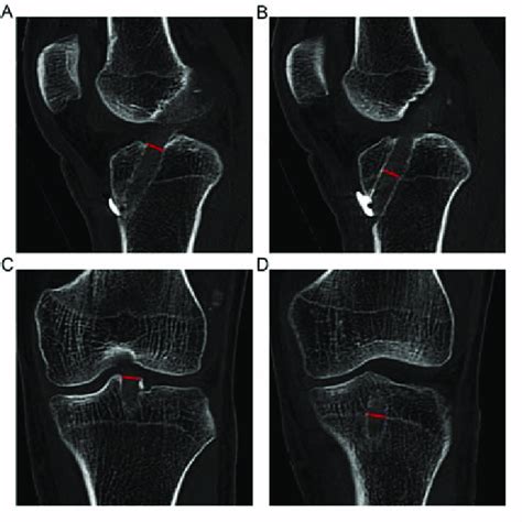 The Measurement Of The Tibial Tunnel Diameter A Plateau On The The Measurement Of The Tibial Tunnel Diameter A Plateau On The