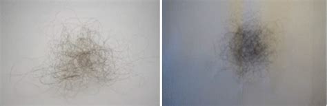 Hair Shedding Everything You Need To Know Wimpole Clinic