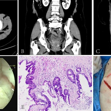 Pre Pelvic Exenteration Colonoscopy Ct Post Operative Pathology And