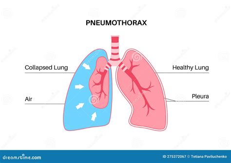 Pneumothorax Anatomical Poster Vector Illustration