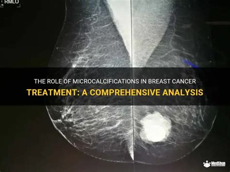 The Role Of Microcalcifications In Breast Cancer Treatment A Comprehensive Analysis Medshun