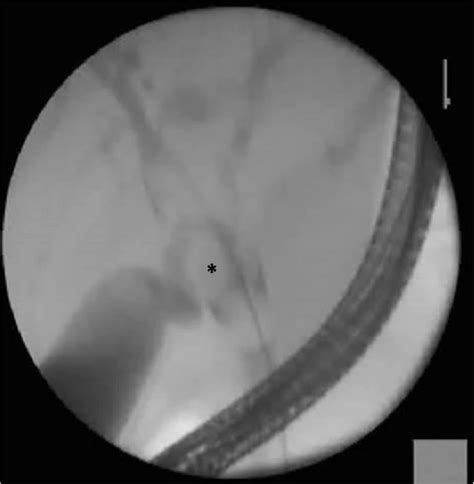 Endoscopic Retrograde Cholangiopancreatogram Image Of The Cystadenoma Download Scientific