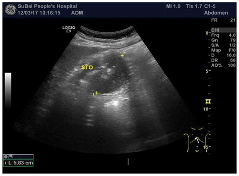 Cellular Schwannoma Arising From The Gastric Wall Misdiagnosed As A