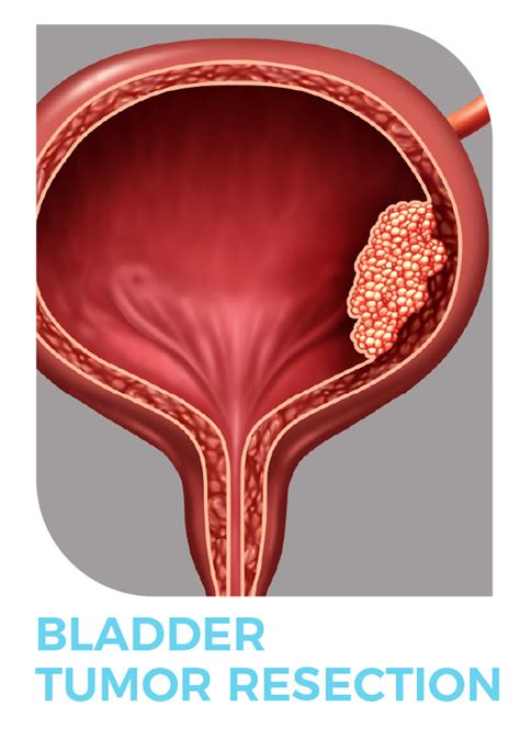 Bladder Tumor Resection Urology Pv