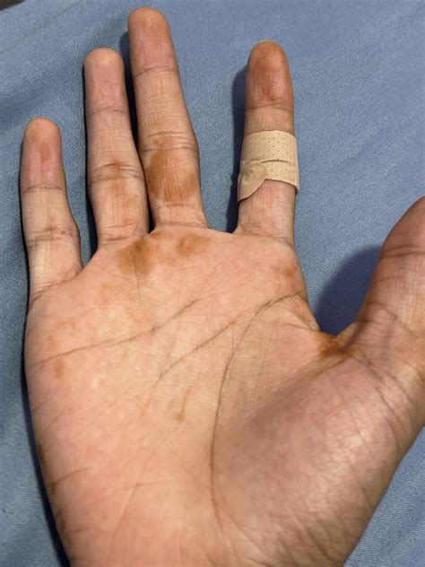 randomly appeared on my hands i m not too sure what this is r medical