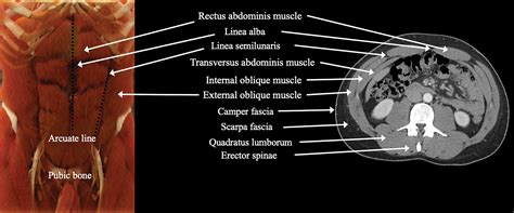 Imaging Of Abdominal Wall Masses Masslike Lesions And Diffuse