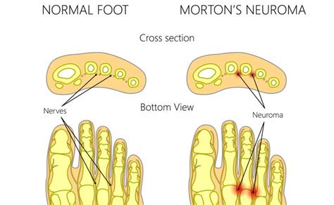 Mortons Neuroma Treatment Yeg Foot And Ankle Inc