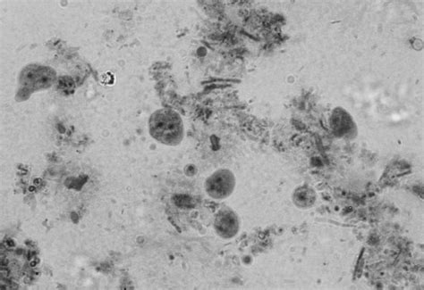Dientamoeba Fragilis Trophozoite