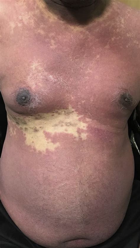 Confluent Erythematous Maculopapular Lesions Over The Chest And Abdomen