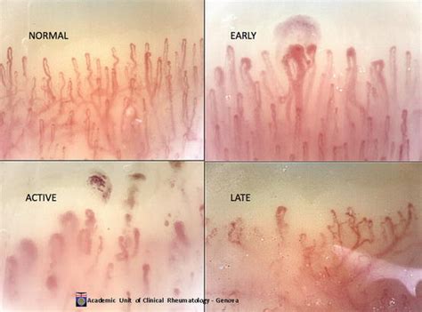 Capillaroscopy Musculoskeletal Key