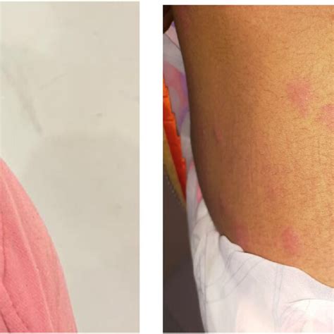 E Case Report 3 Pyrazinamide Induced Exfoliative Dermatitis Download Scientific Diagram