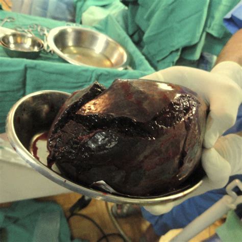 E Post Operative Splenectomy Specimen Photograph Demonstrates An Download Scientific Diagram