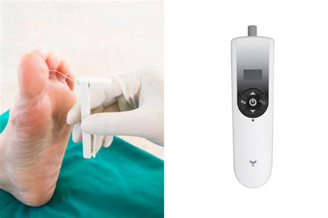 Biothesiometer Vs Monofilament Which Is Better For Diabetic Biothesiometer Vs Monofilament Which Is Better For Diabetic
