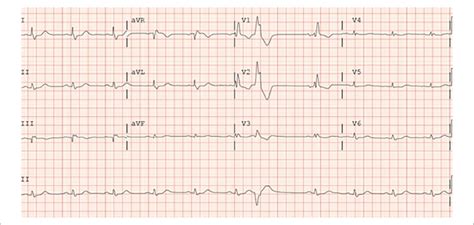 Electrocardiogram Showing Sinus Rhythm Right Bundle Branch Block And Download Scientific