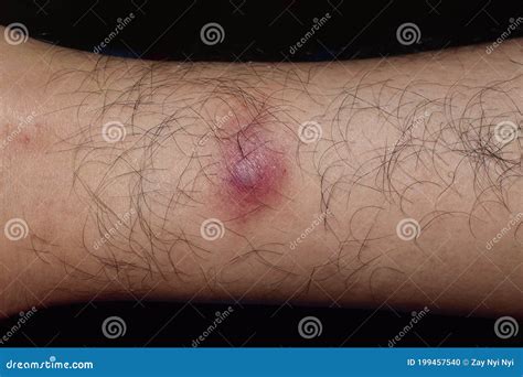 Cellulitis Or Staphylococcal Streptococcal Skin Infection In Leg Of Asian Burmese Male Patient
