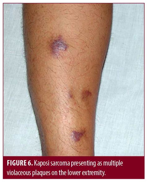 Fronekfigure6 Jcad The Journal Of Clinical And Aesthetic Dermatology