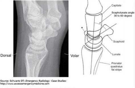 Lunate Dislocation Core Em