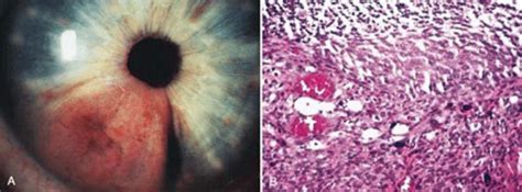 Pathology Of The Uvea Ento Key
